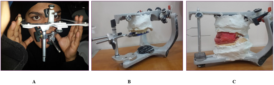 Innovative Prosthodontic Approach for Treating Hypodontia: A Case Report