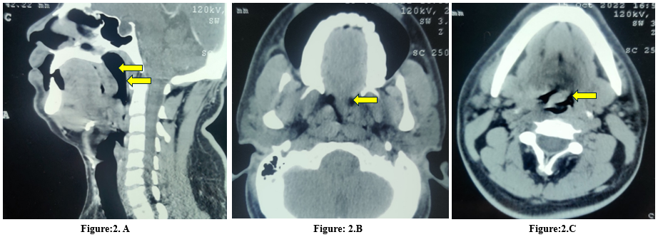 Surgical Management of Uvular Hypertrophy: An Unusual Case Report